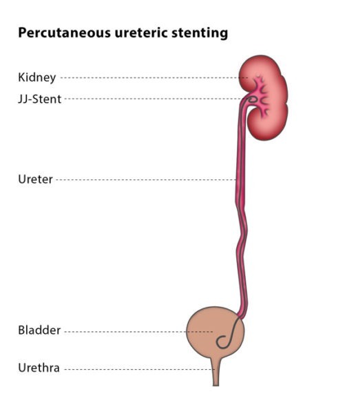 Stent ureteral doble quirúrgico disponible de Lithotripsy J de la urología